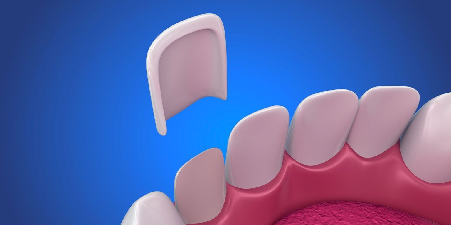 Dental Veneers - Understanding the Procedure - Dentist Minneapolis